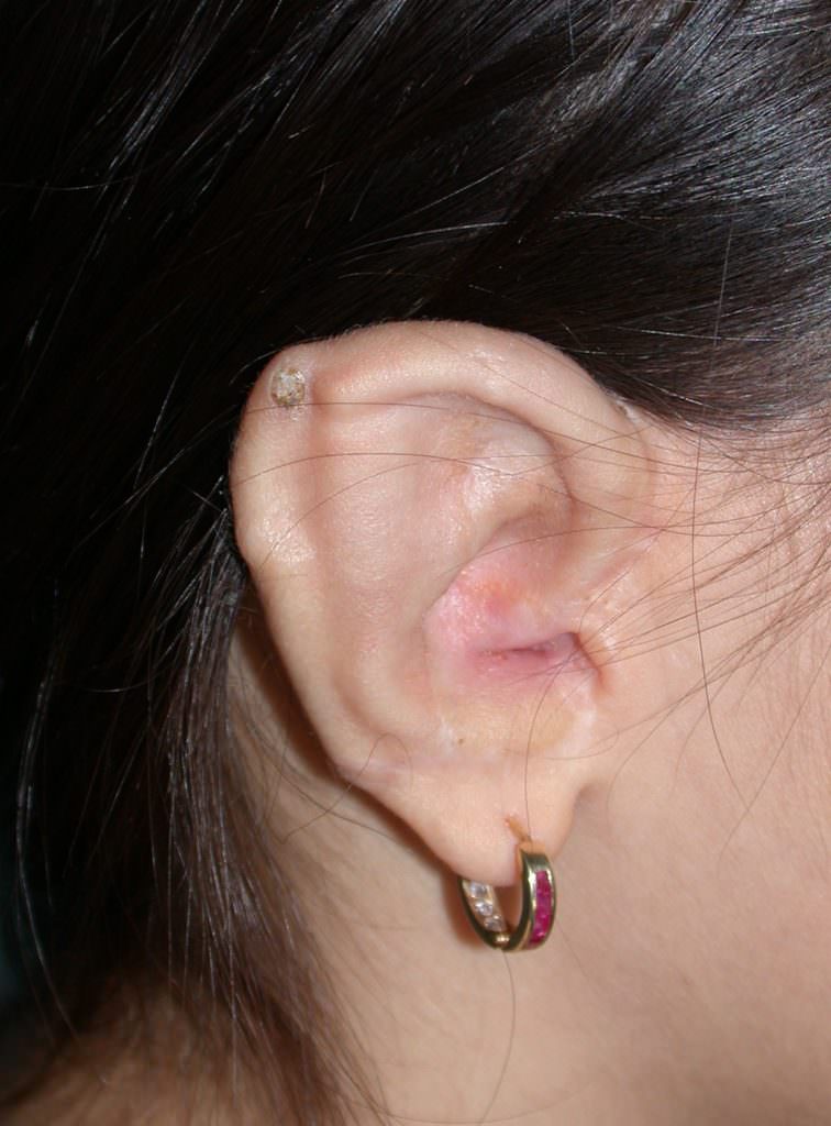 Medpor Implant Exposure in Reconstruction - Tahiri Plastic Surgery